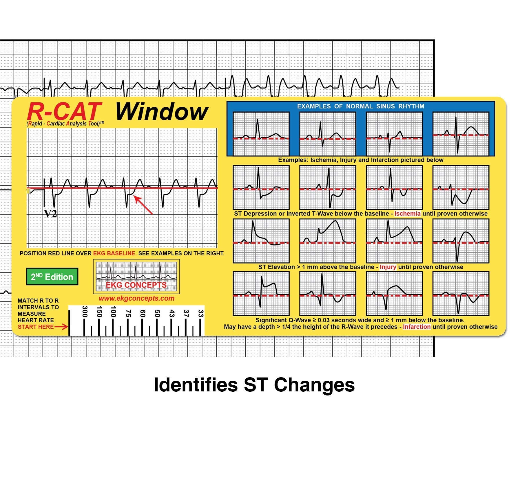 R-CAT EKG Window 2nd Edition