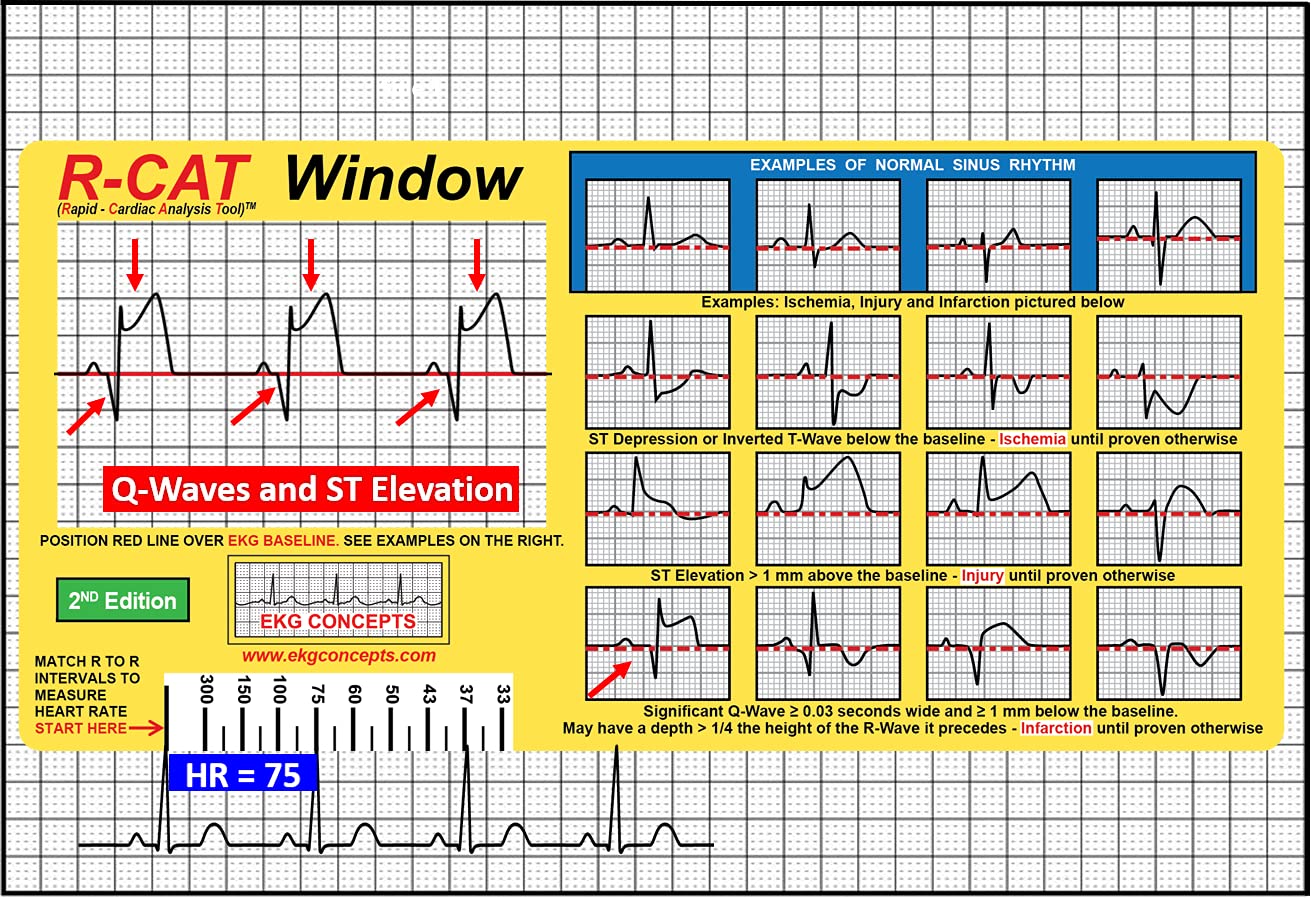 R-CAT EKG Window 2nd Edition