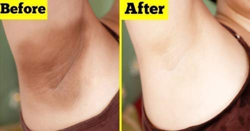 TOWELL Crema Aclaradora Para Piel Manchas En Cara Axilas Cuello Entrepierna