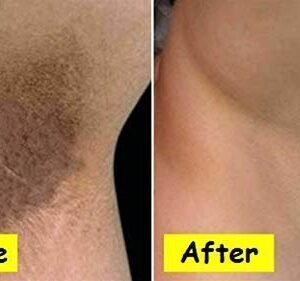 TOWELL Crema Aclaradora Para Piel Manchas En Cara Axilas Cuello Entrepierna