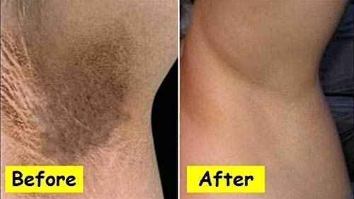 TOWELL Crema Aclaradora Para Piel Manchas En Cara Axilas Cuello Entrepierna