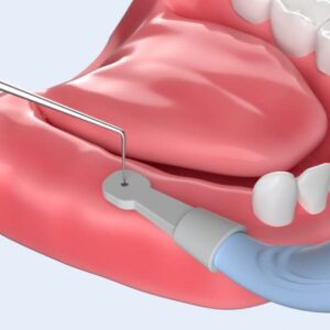 Dental Implant Detector Three-Dimensional Implant Locator Easydo-Detector with 3PCS Sensor Heads