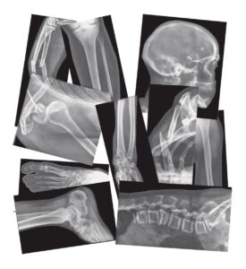 roylco broken bones x-rays – 15 realistic fracture images for stem/steam learning, classroom anatomy, health education, and labs – perfect for teachers, parents, and medical training