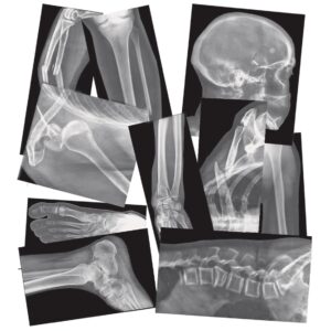 Roylco Broken Bones X-Rays – 15 Realistic Fracture Images for STEM/STEAM Learning, Classroom Anatomy, Health Education, and Labs – Perfect for Teachers, Parents, and Medical Training