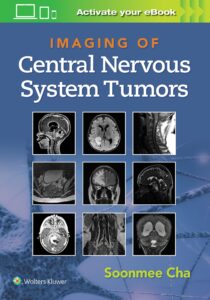 imaging of central nervous system tumors