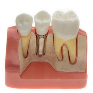 analysis model for dental implant crown bridge demonstration teeth model for education m2017